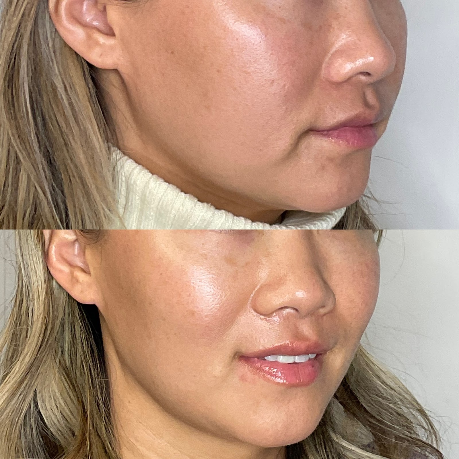 Nefertiti Lift | Simply.Aesthetics | Non-Surgical Neck Lift